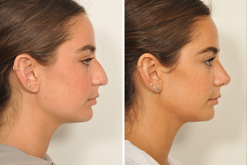 Rhinoplasty Tuneesias: hind ja lõplik juhend