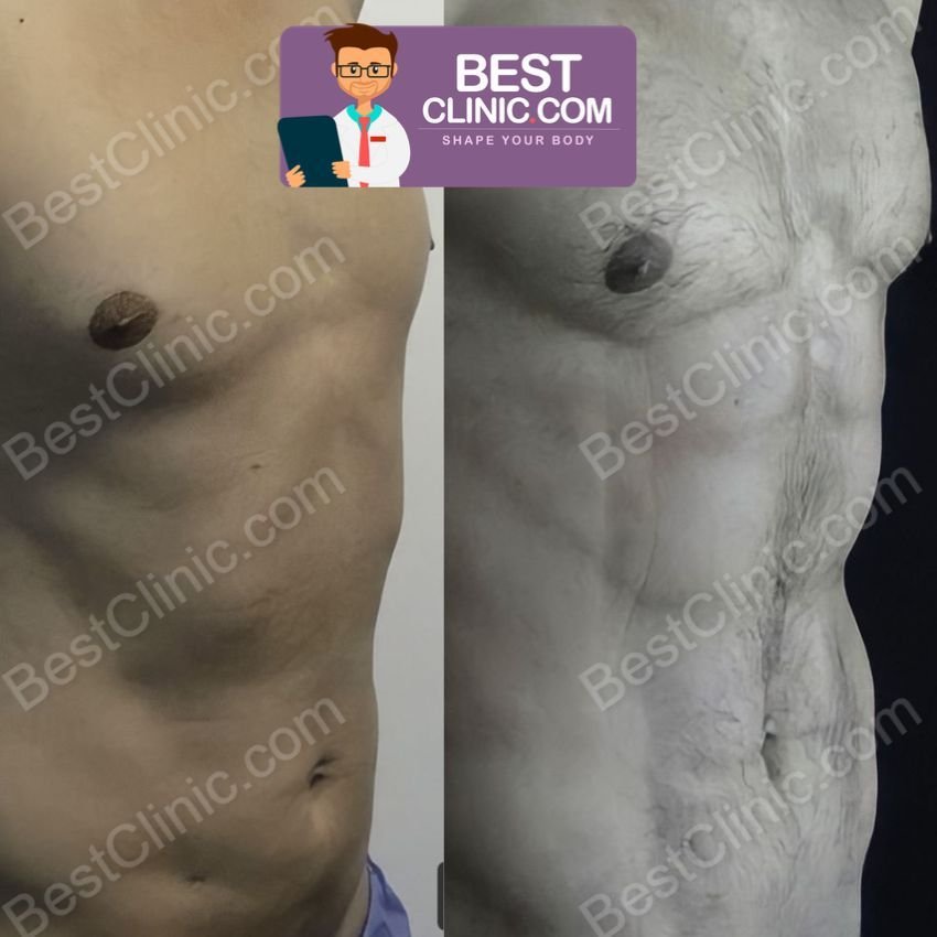 Rasvaimu Kuuepakk Türkiye: hind ja protseduur